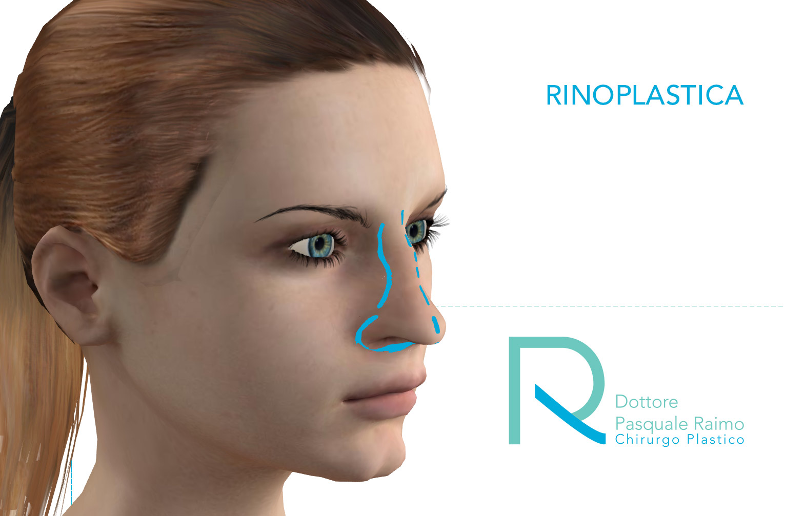 RINOPLASTICA correzione inestetismi del naso - Dottore Pasquale Raimo